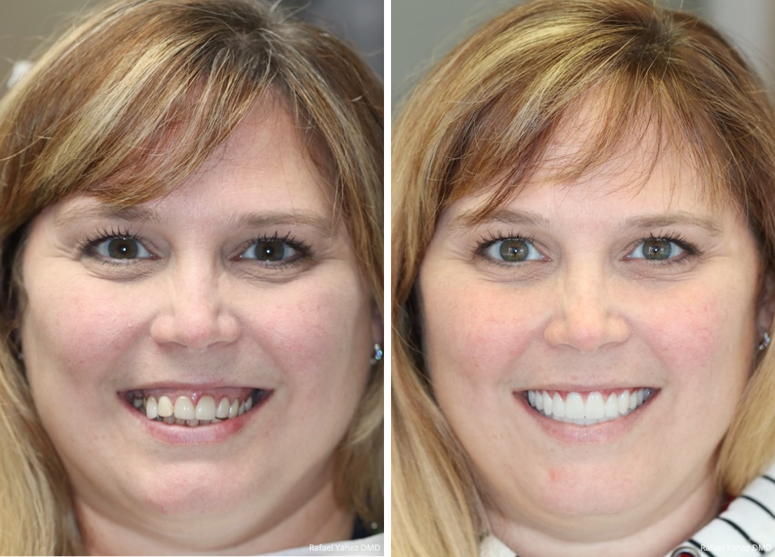 Dental Veneers Guide To Types Procedure Costs In The Uk 56 Off